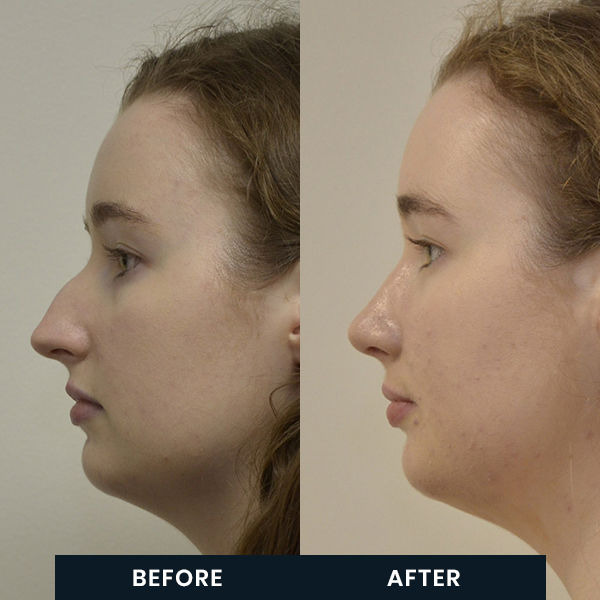 Rhinoplasty Surgery: What to do immediately after your rhinoplasty - Dr ...