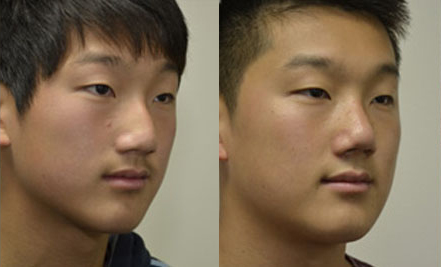 Post-Rhinoplasty Care Instructions - Dr. Gillian Dunlop