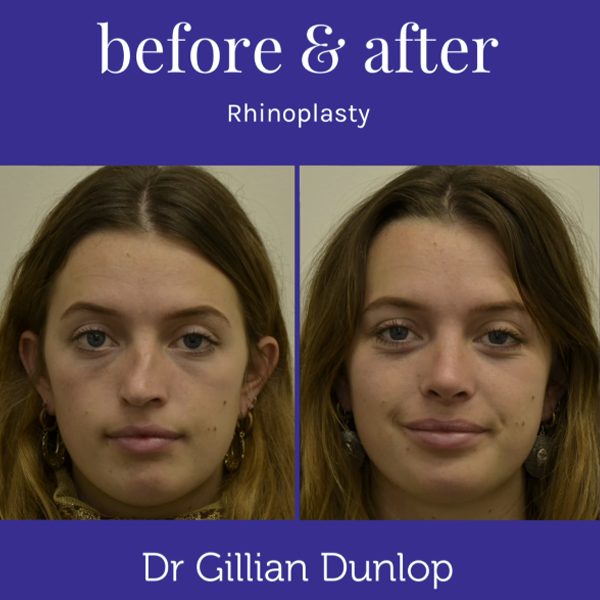 Rhinoplasty Swelling Timeline & Recovery | Dr Gillian Dunlop