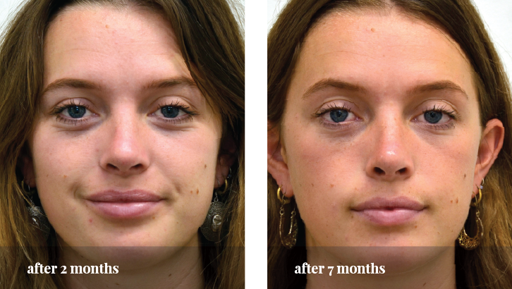 Rhinoplasty Swelling Timeline & Recovery | Dr Gillian Dunlop